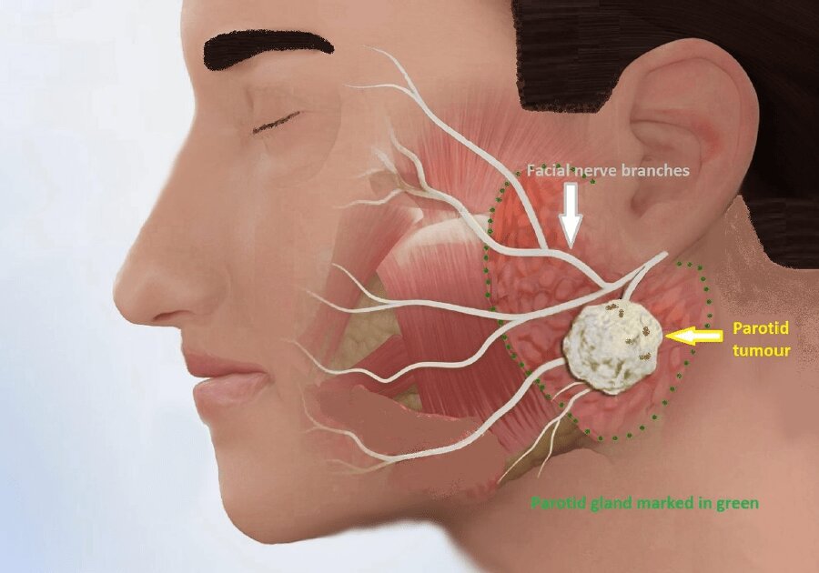 Submandibular Tumor Submandibular Tumor