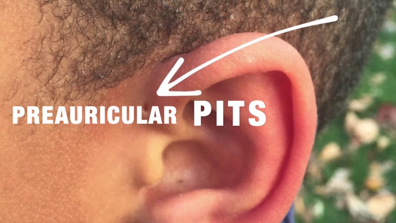 Preauricular Pits with Dr. David Mener | ENT and Allergy Associates