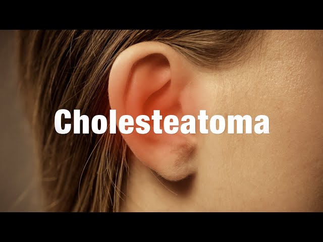 Cholesteatoma with Dr. Eric Smouha | ENT and Allergy Associates